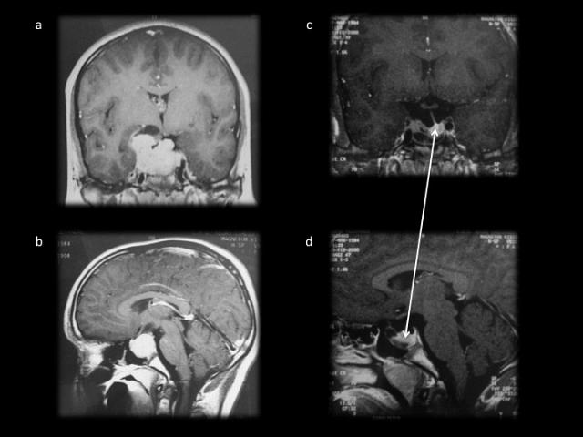 Adénomes hypophysaires - Campus de Neurochirurgie
