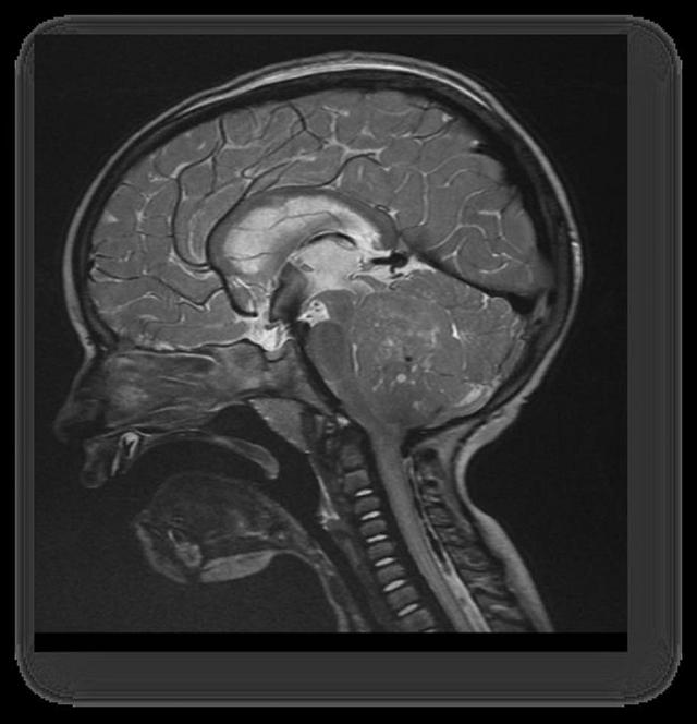 #11 Items 297 et 299 : Tumeurs intracrâniennes de l'enfant - Campus de Neurochirurgie