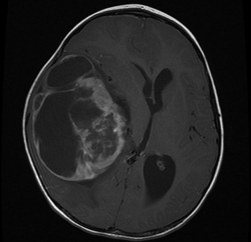 #11 Items 297 et 299 : Tumeurs intracrâniennes de l'enfant - Campus de ...