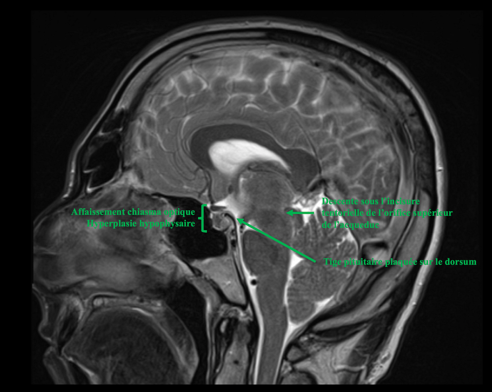 #3.5 Hypotension intracrânienne - Campus de Neurochirurgie